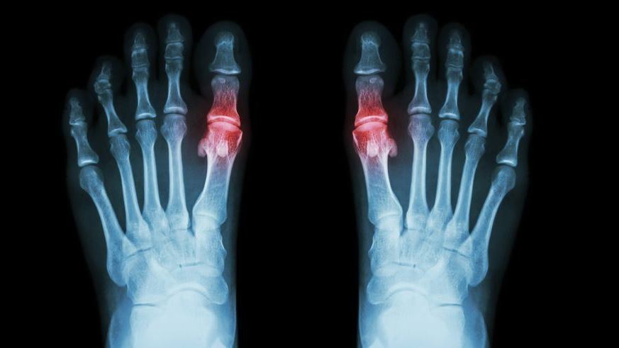 What you don't know about Gout or the Kings Disease | Daleeeel.com