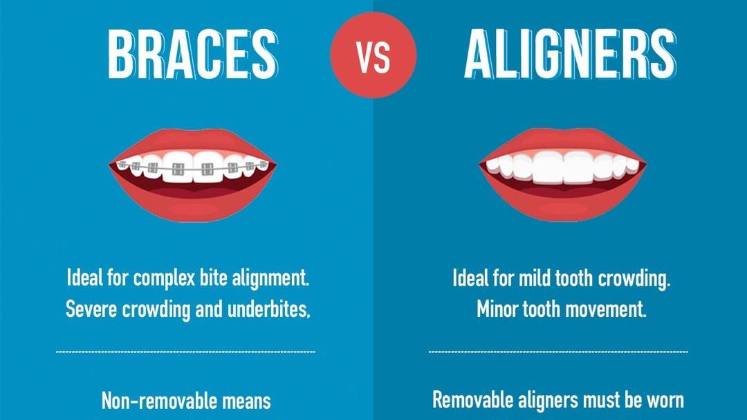 What are the main differences between Braces and Aligners? | Daleeeel.com